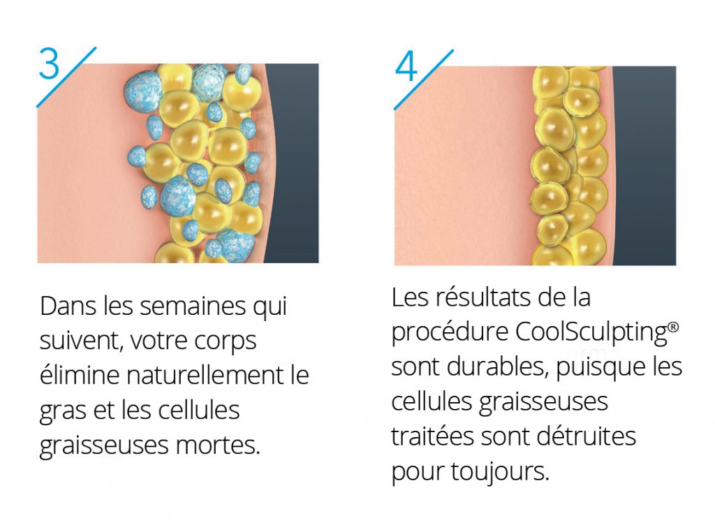 Coolsculpting - Institut Oderma