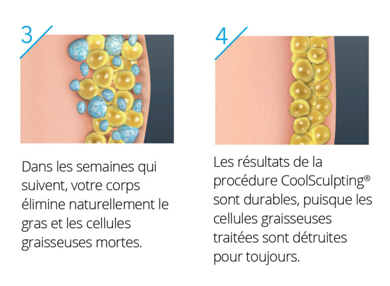 Coolsculpting - Institut Oderma