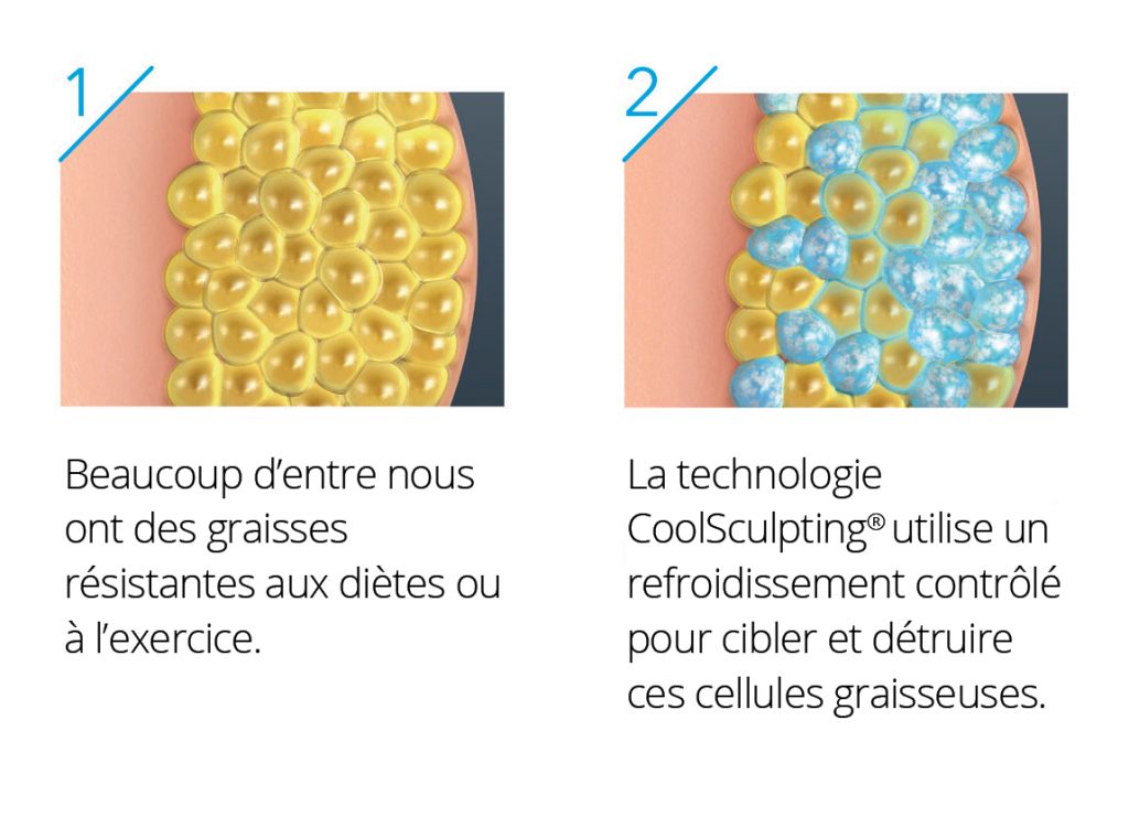 Coolsculpting - Institut Oderma