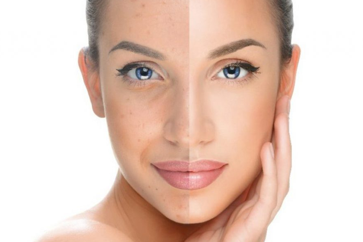 Traiements des Taches pigmentaires - Institut Oderma