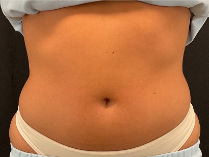 CoolTone - Institut Oderma