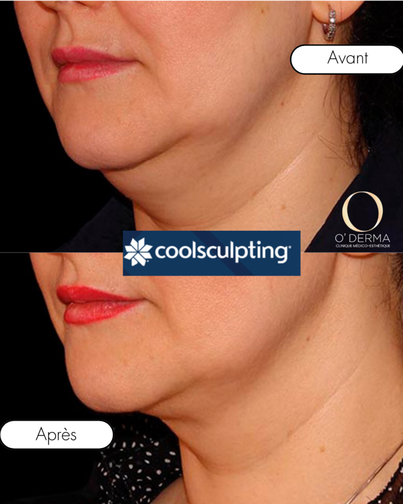 Pourquoi le CoolSculpting est le Traitement Vedette de Notre Clinique ? - Institut Oderma