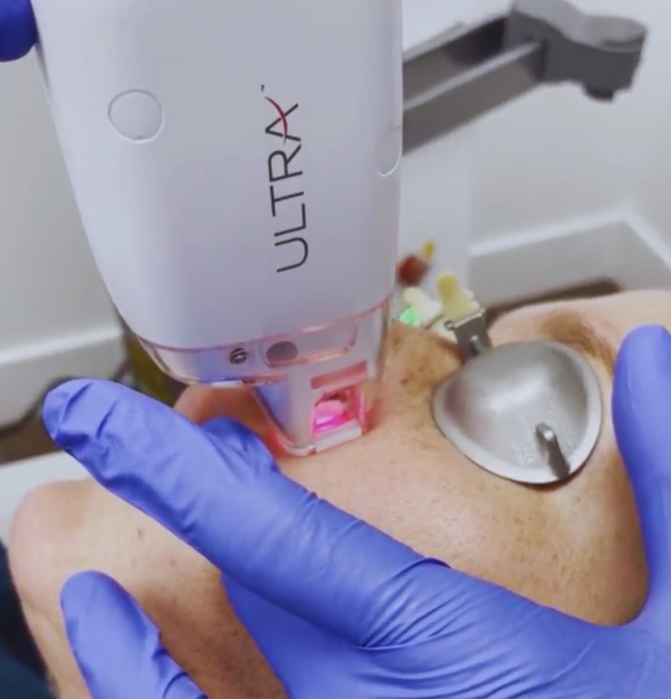 LaseMD Ultra Laser Thulium - Institut Oderma