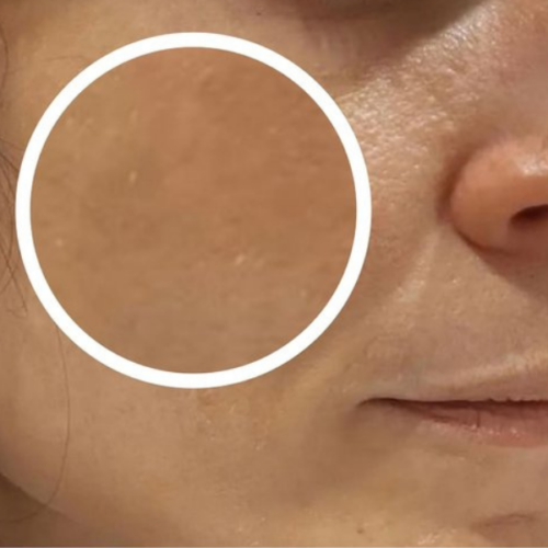 LaseMD Ultra Laser Thulium - Institut Oderma