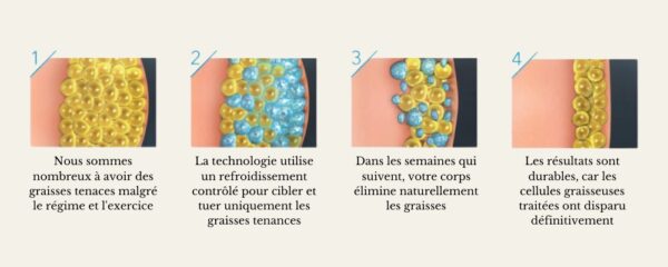 Coolsculpting - Institut Oderma